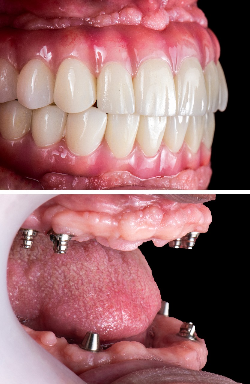 Hybrid Dentures Glastonbury, CT | Hybrid Dentures Near Me | Purple Dental